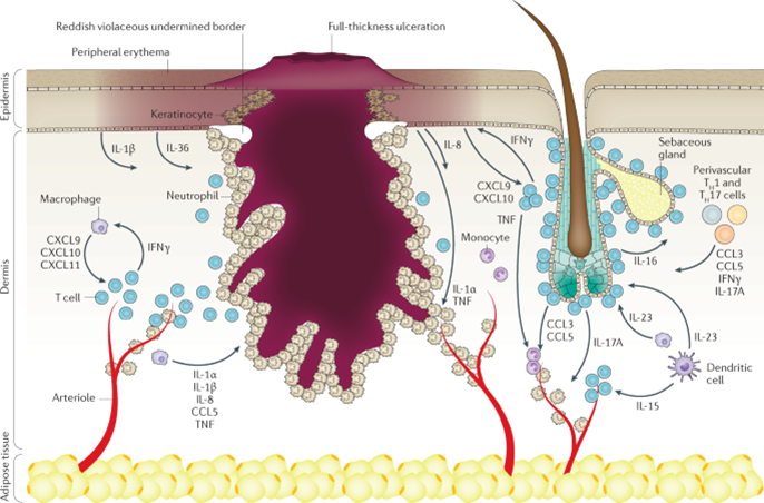 38. Pyoderma Gangrenosum After Breast Surgery: Diagnostic Pearls and ...